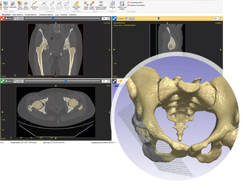 Simpleware 軟體於醫療 3D 列印的應用 - 艾索科技